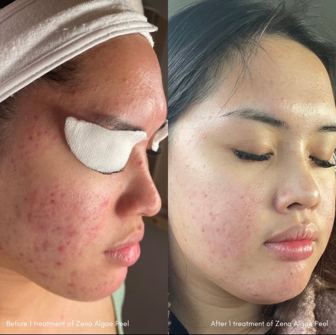 Fresh Start — Zena Algae Peel | KRX Green Sea Bundle | Dear Me, Take ...